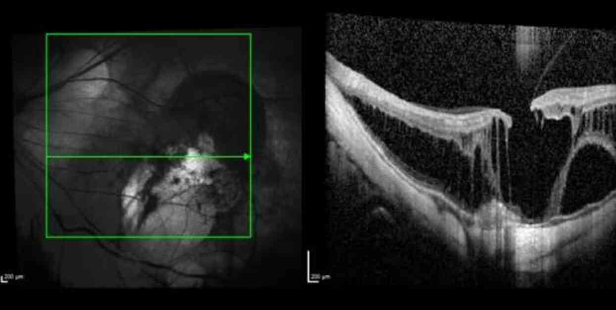 Miyop Nedir? Miyop Belirtileri, Nedenleri ve Tedavisi - Haberler