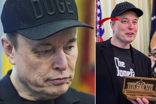 "Explosive claim regarding the bruise in Elon Musk's eye."